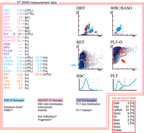 Anemia sideroblastica reattiva alla piridixina - Ematologia in Fluorescenza
